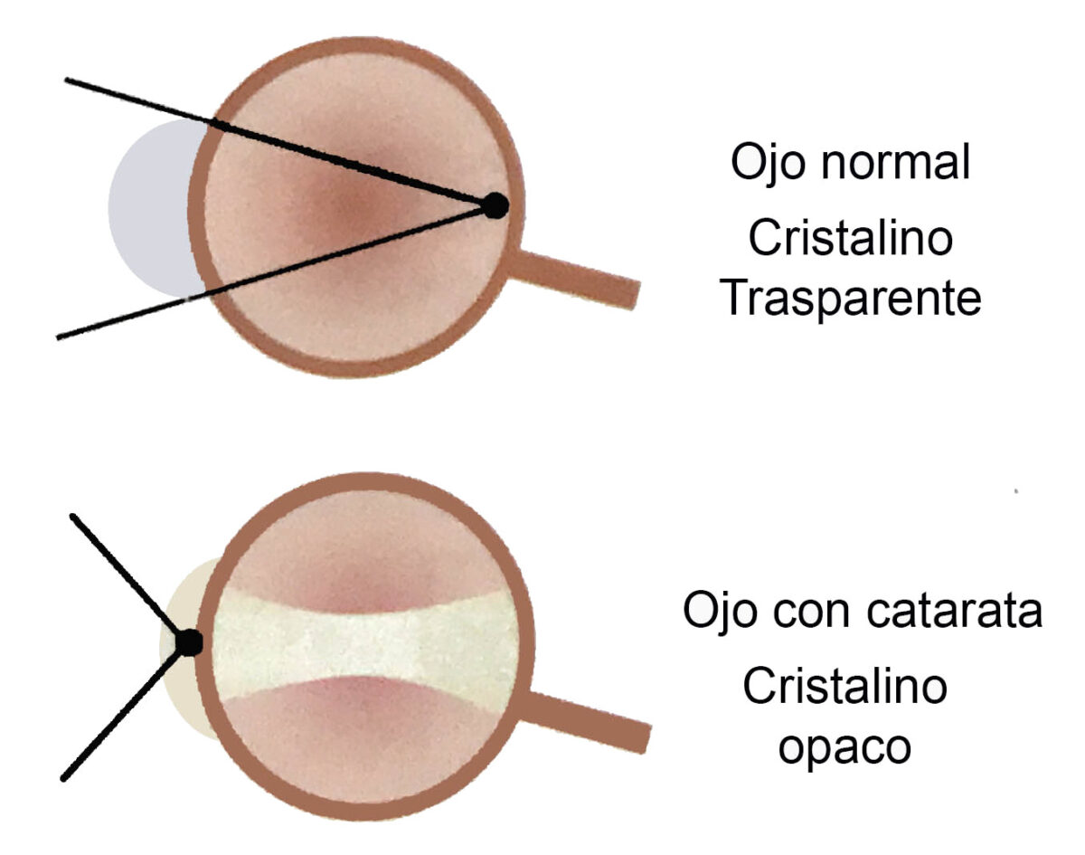Cirugía de Catarata - Centro Laser Ocular